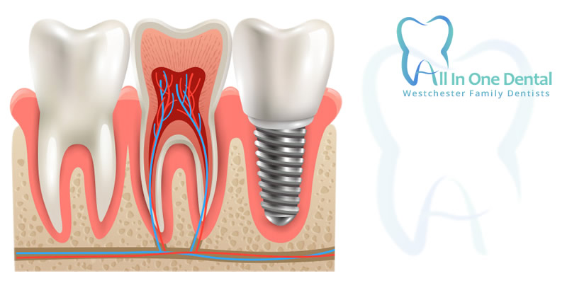 Wisdom Tooth Extractions 5 Facts You Need to Know | All In One Dental ... Wisdom Tooth Extractions 5 Facts You Need to Know | All In One Dental ...